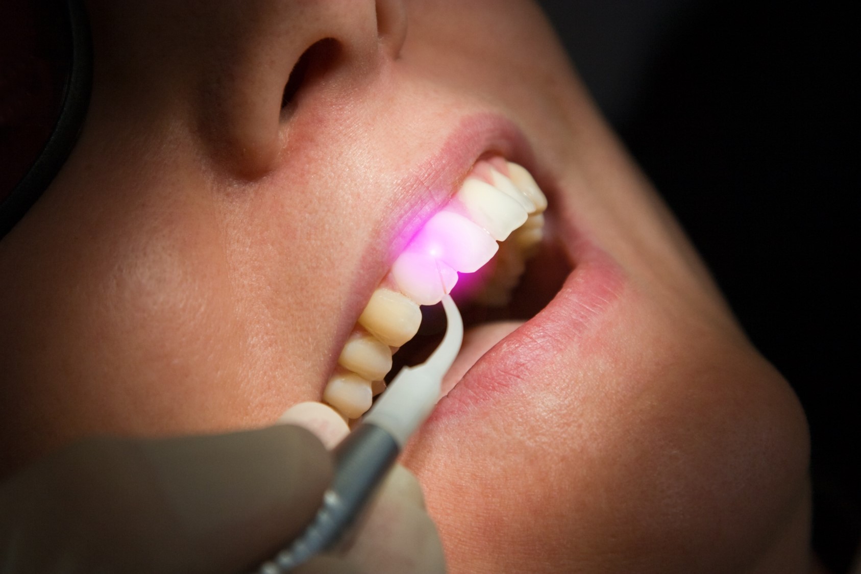 3 Benefits of Gum Recontouring with Laser Dentistry